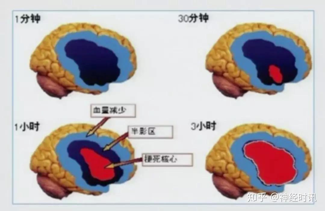 急性缺血性脑卒中的影像学评估 知乎