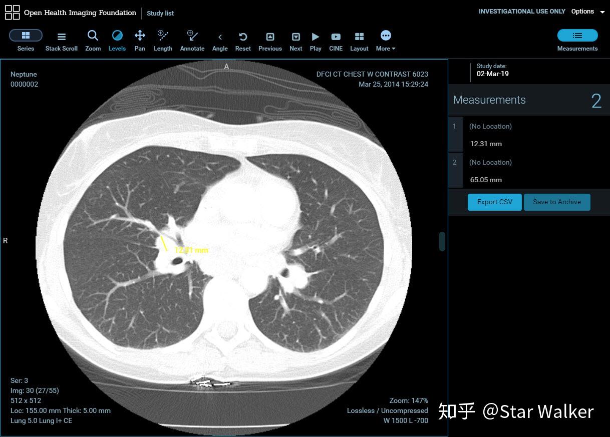 从Cornerstone到OHIF Viewer—JS影像前端开发最佳范例 - 知乎