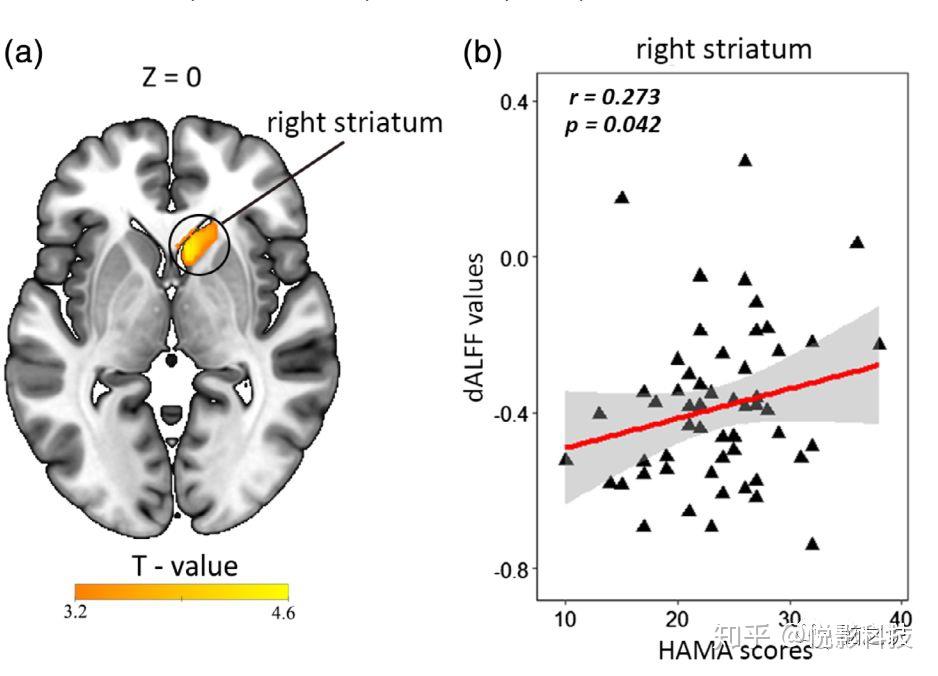 Human Brain Mapping：广泛性焦虑症患者低频振幅ALFF的动态变化 - 知乎