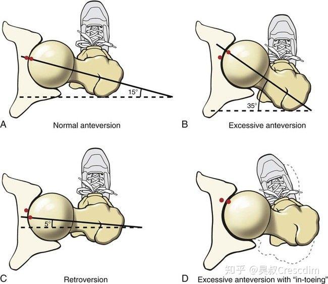 什么情况下，双盘（全莲花坐）容易损伤膝关节？ - 知乎